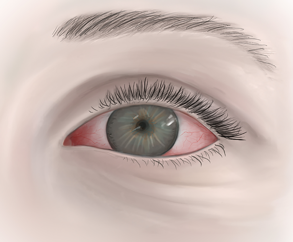Eye Conditions and Diseases